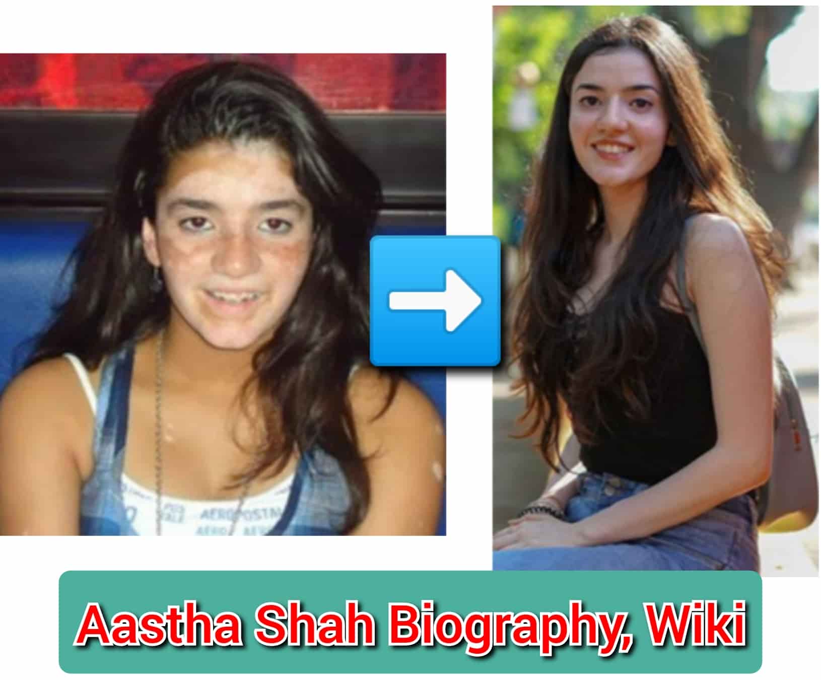 Aastha Shah Biography, Age, Boyfriend, Vitiligo, Family & More - UNIQUE ...